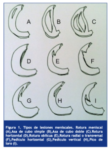 Lesión de menisco: tipos y tratamientos | Clínicas Enric Gallofré